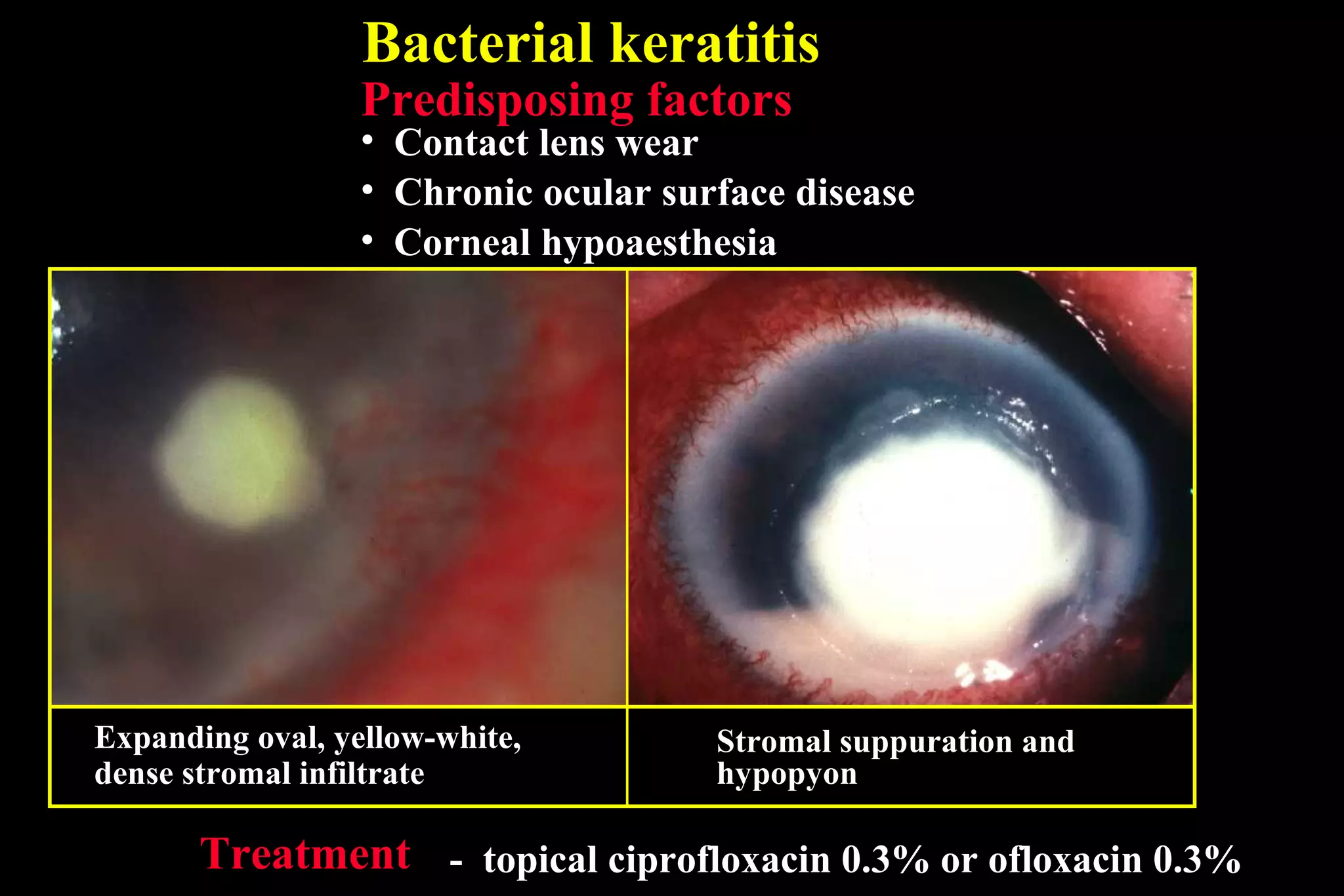 corneal infections | PPT