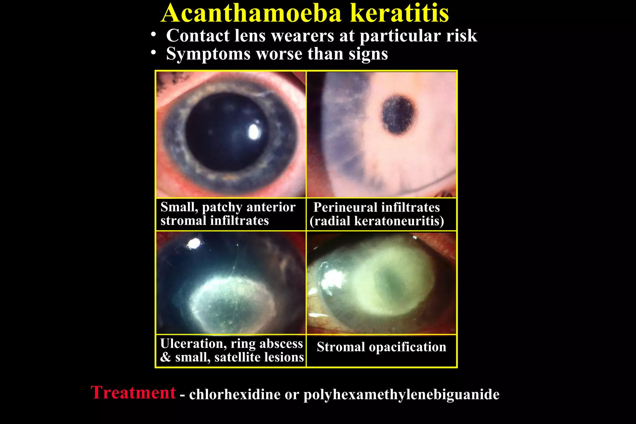 corneal infections | PPT
