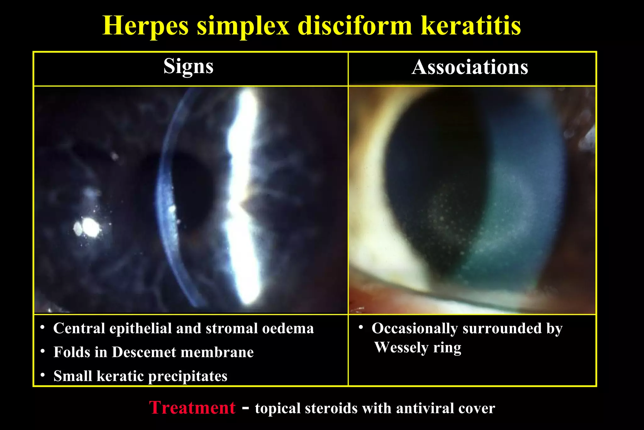 corneal infections | PPT