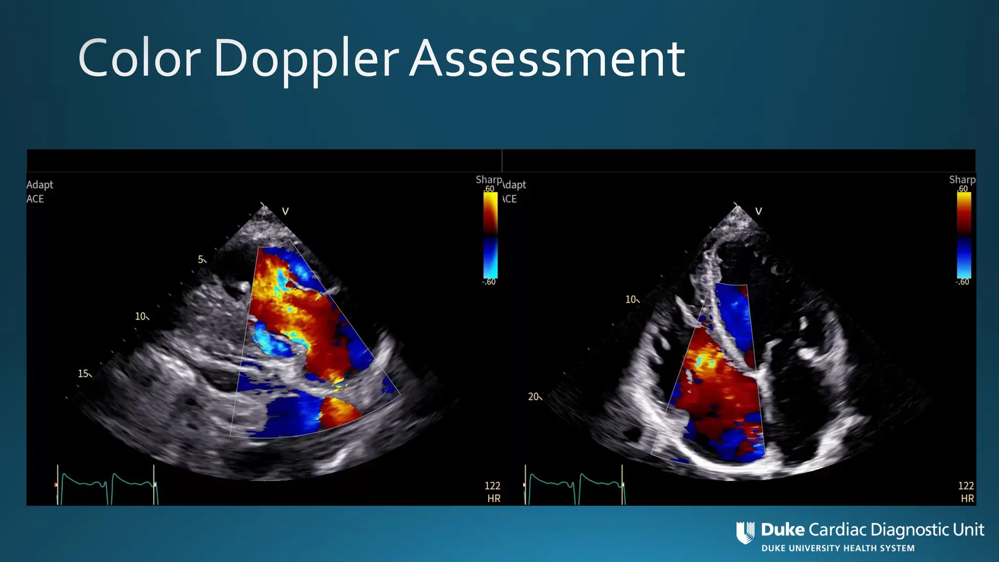 Pre-Procedure Transthoracic Echo: Sonographer Must Do's | PDF
