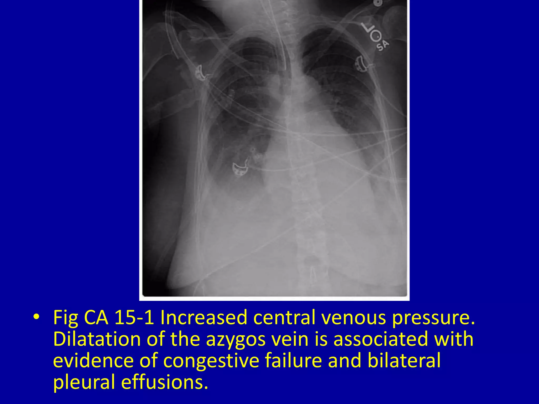 15 dilatation of the azygos vein | PPT