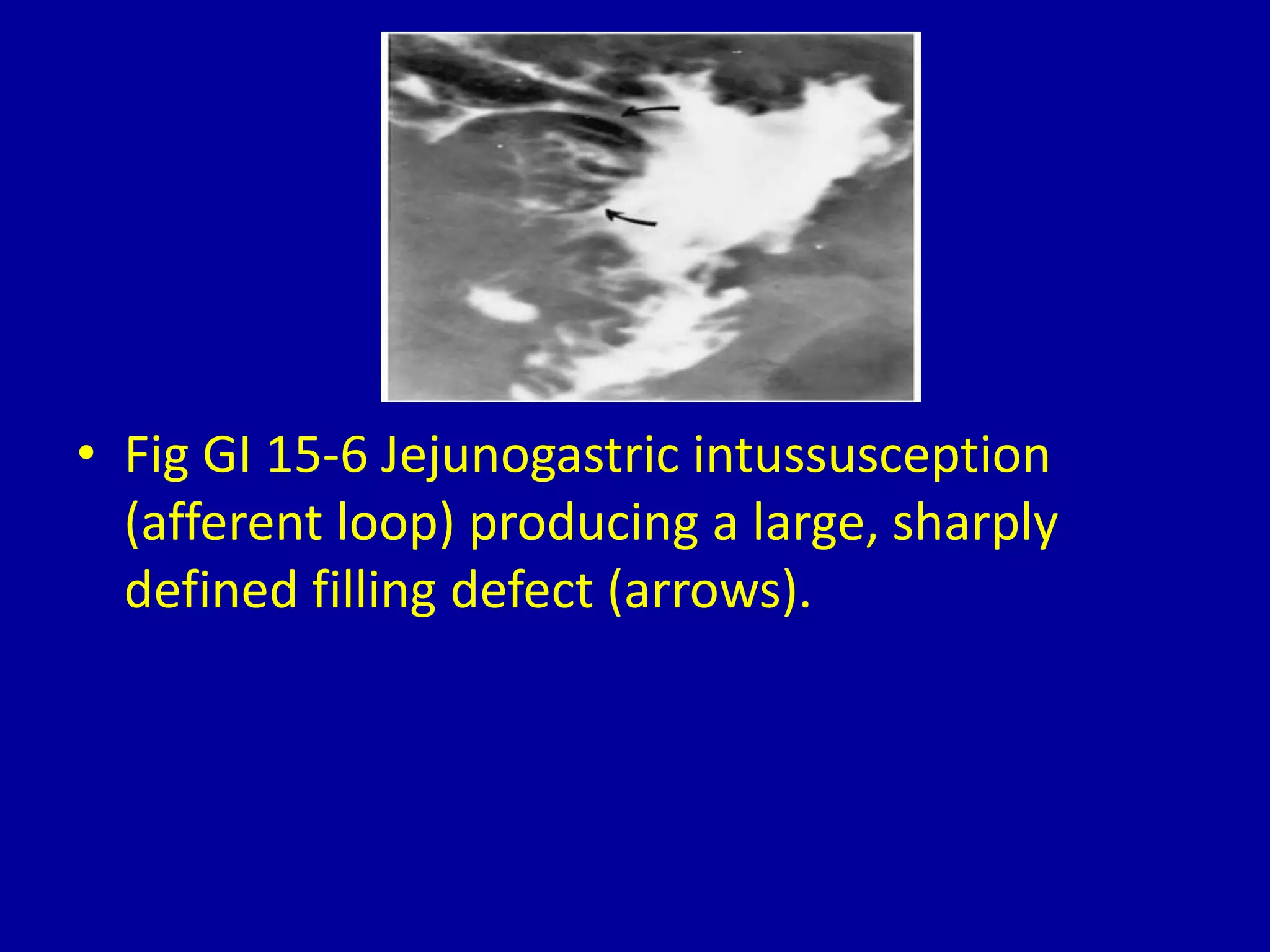 15 filling defects in the gastric remnant | PPT