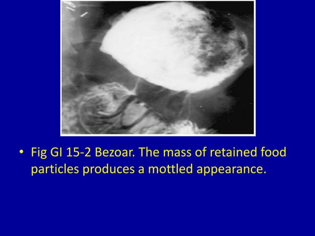 15 filling defects in the gastric remnant | PPT