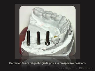15 mandibular posteriorcase ll near & angular corrections | PPT