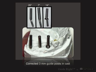 15 mandibular posteriorcase ll near & angular corrections | PPT