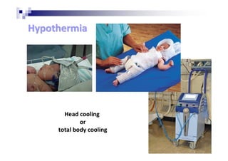 Therapeutic hypothermia for neonatal hypoxic-ischemic encephalopathy | PDF