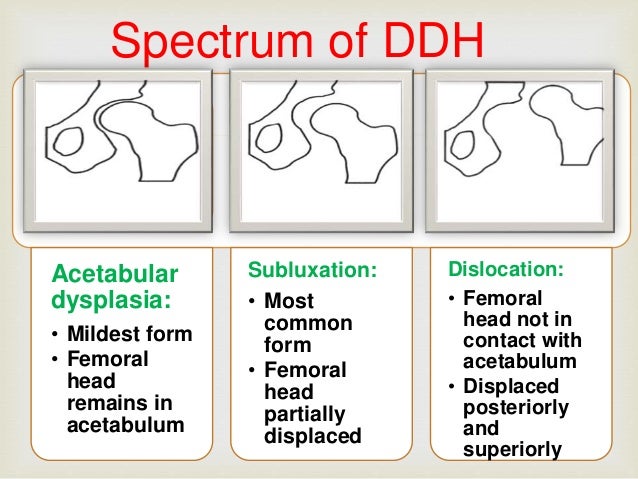 pediatric hip dioerders