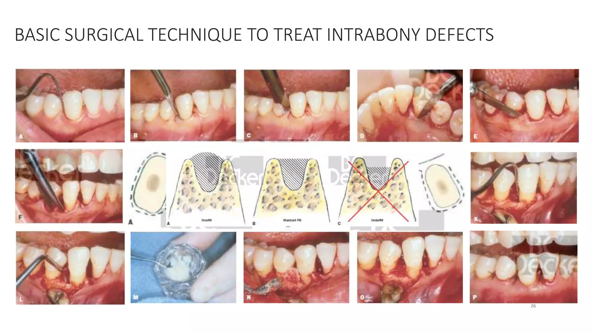 Regenerative Periodontal Surgery | PPTX