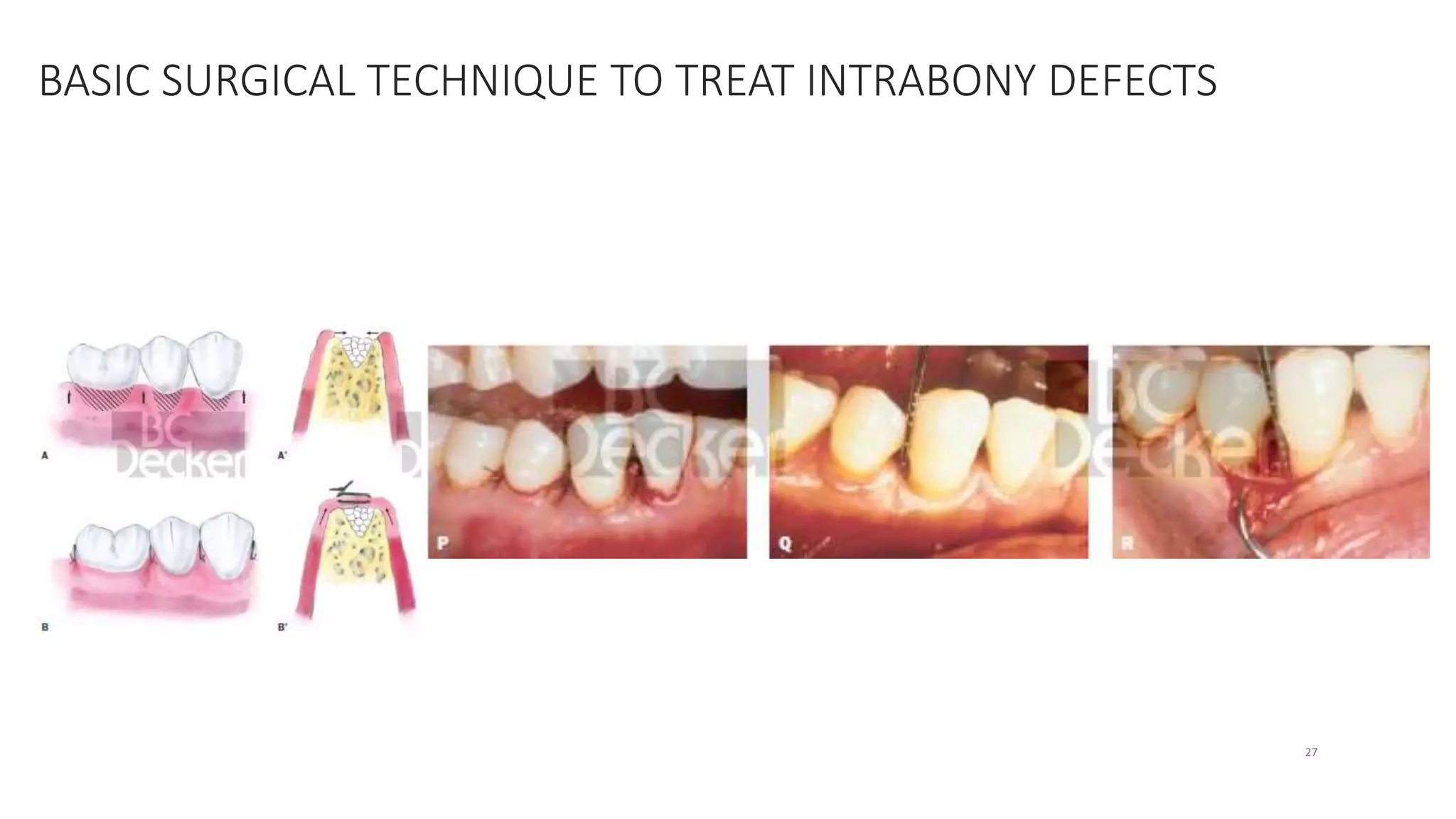 Regenerative Periodontal Surgery | PPTX