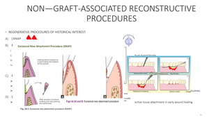 Regenerative Periodontal Surgery | PPTX