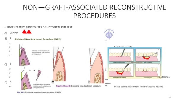 Regenerative Periodontal Surgery | PPTX | Dental Health | Diseases and ...