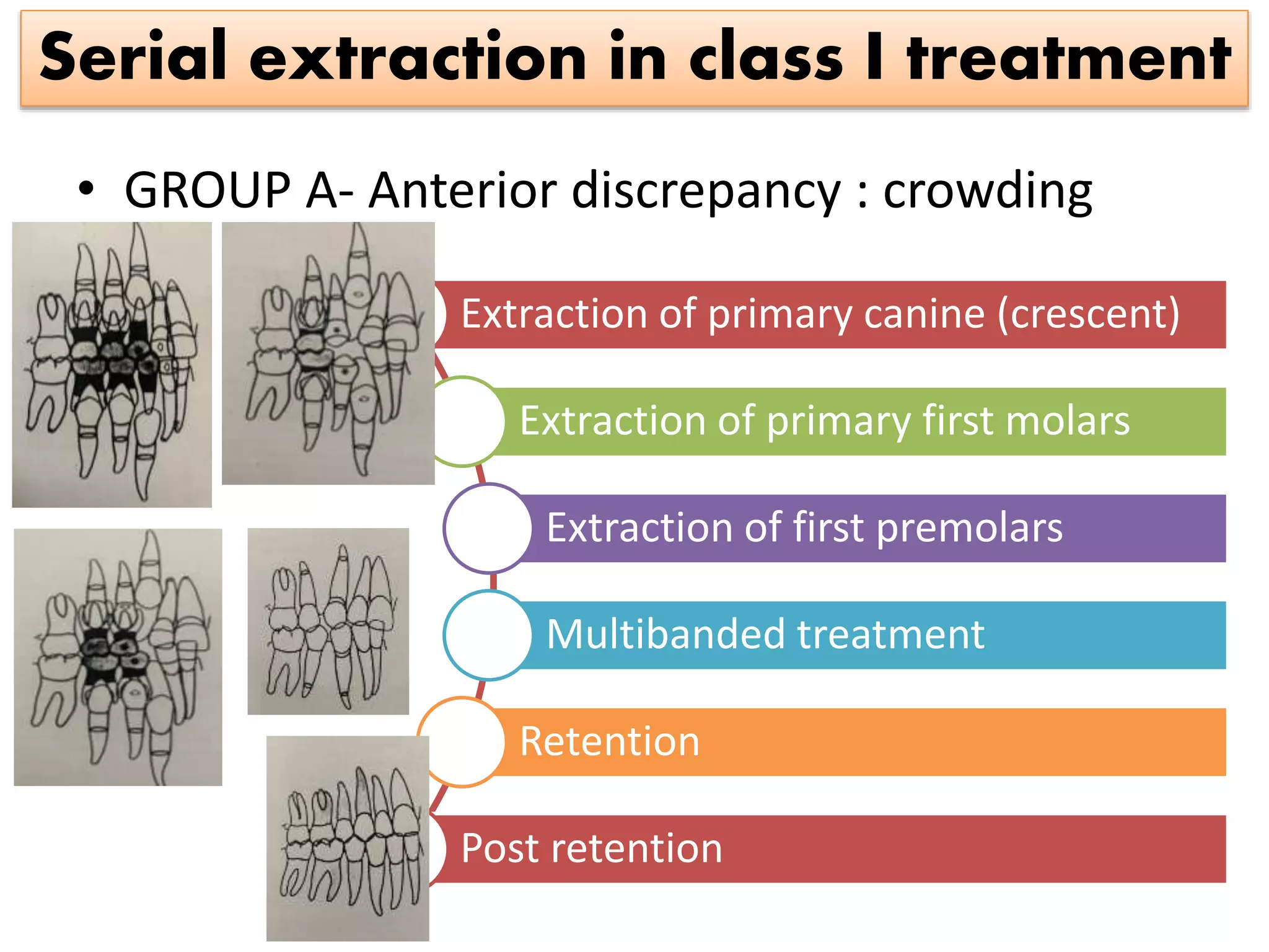 serial extraction | PPTX