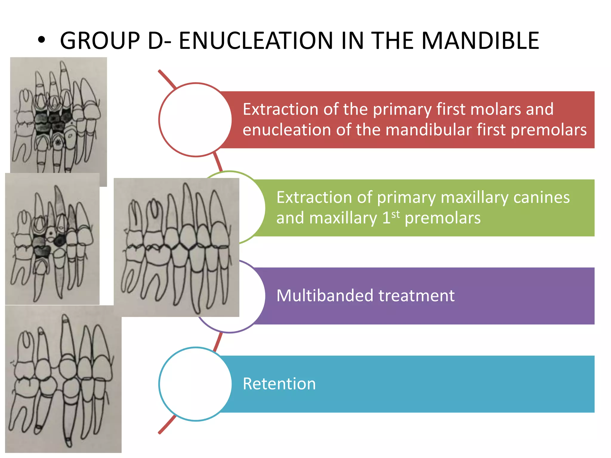 serial extraction | PPTX
