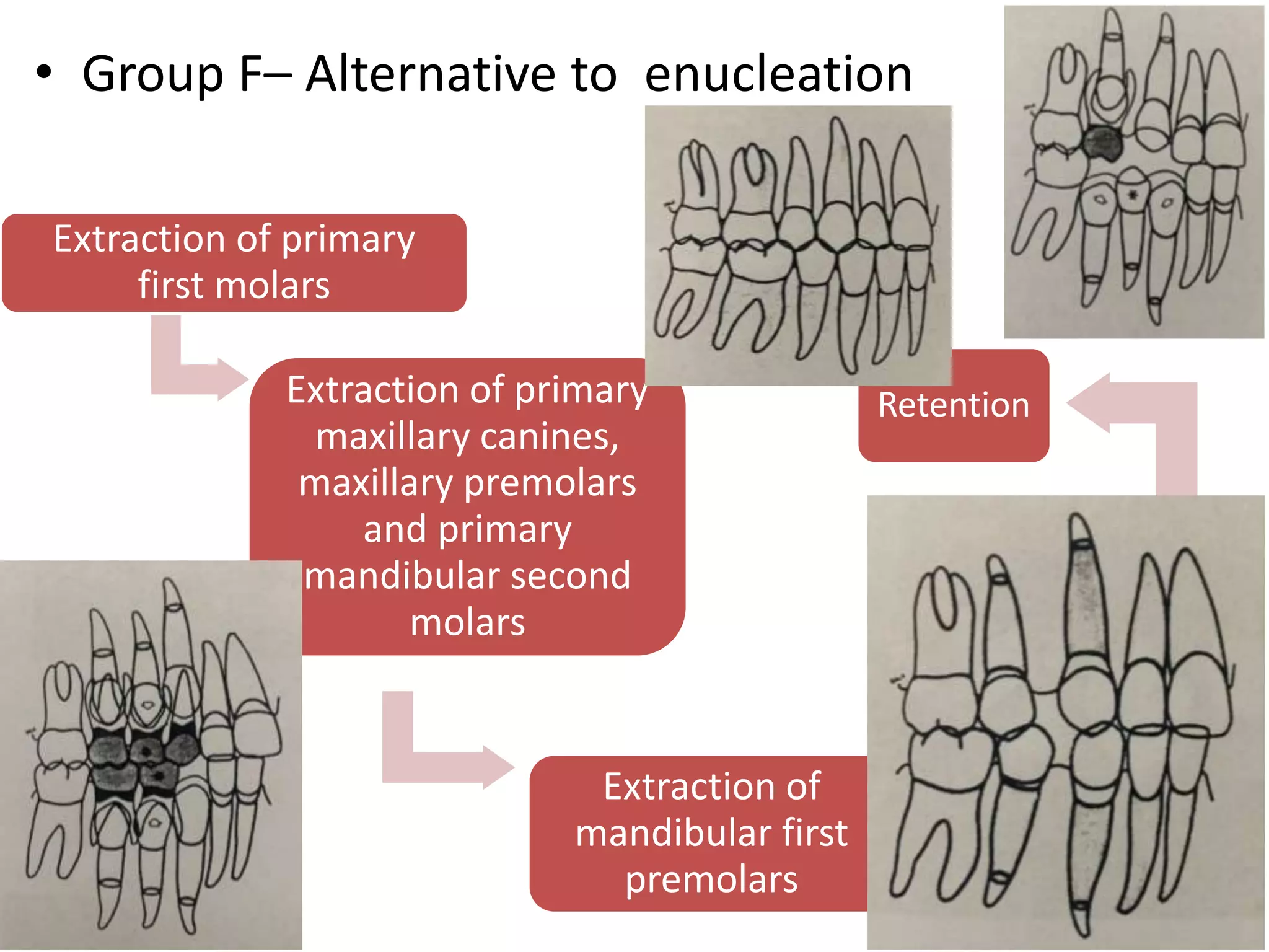 serial extraction | PPTX