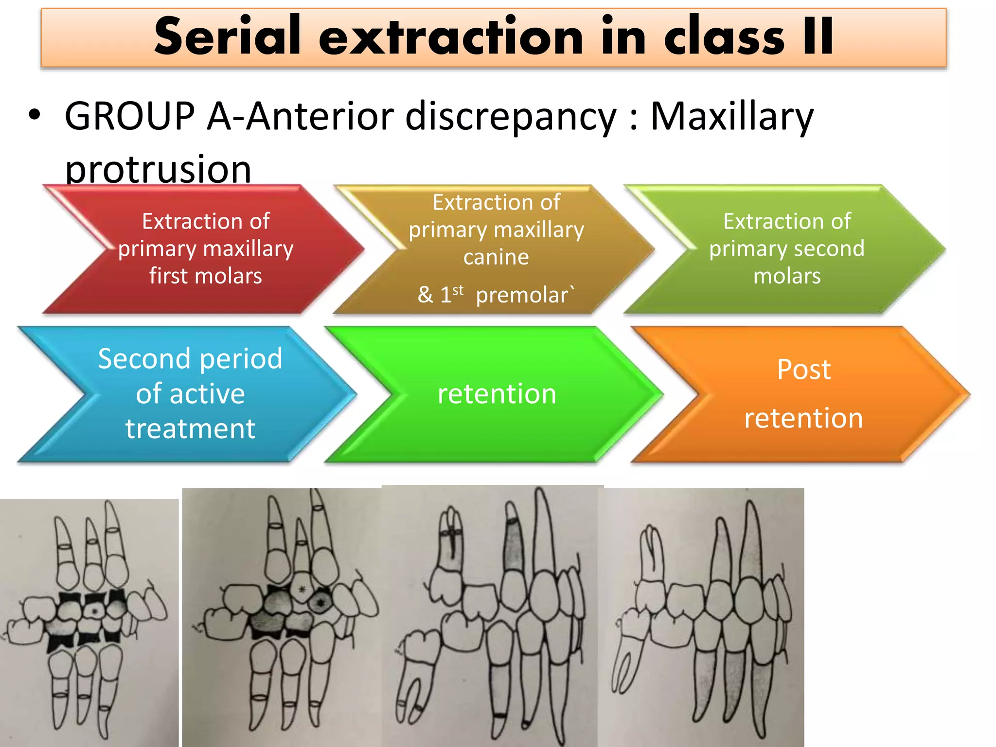 serial extraction | PPTX