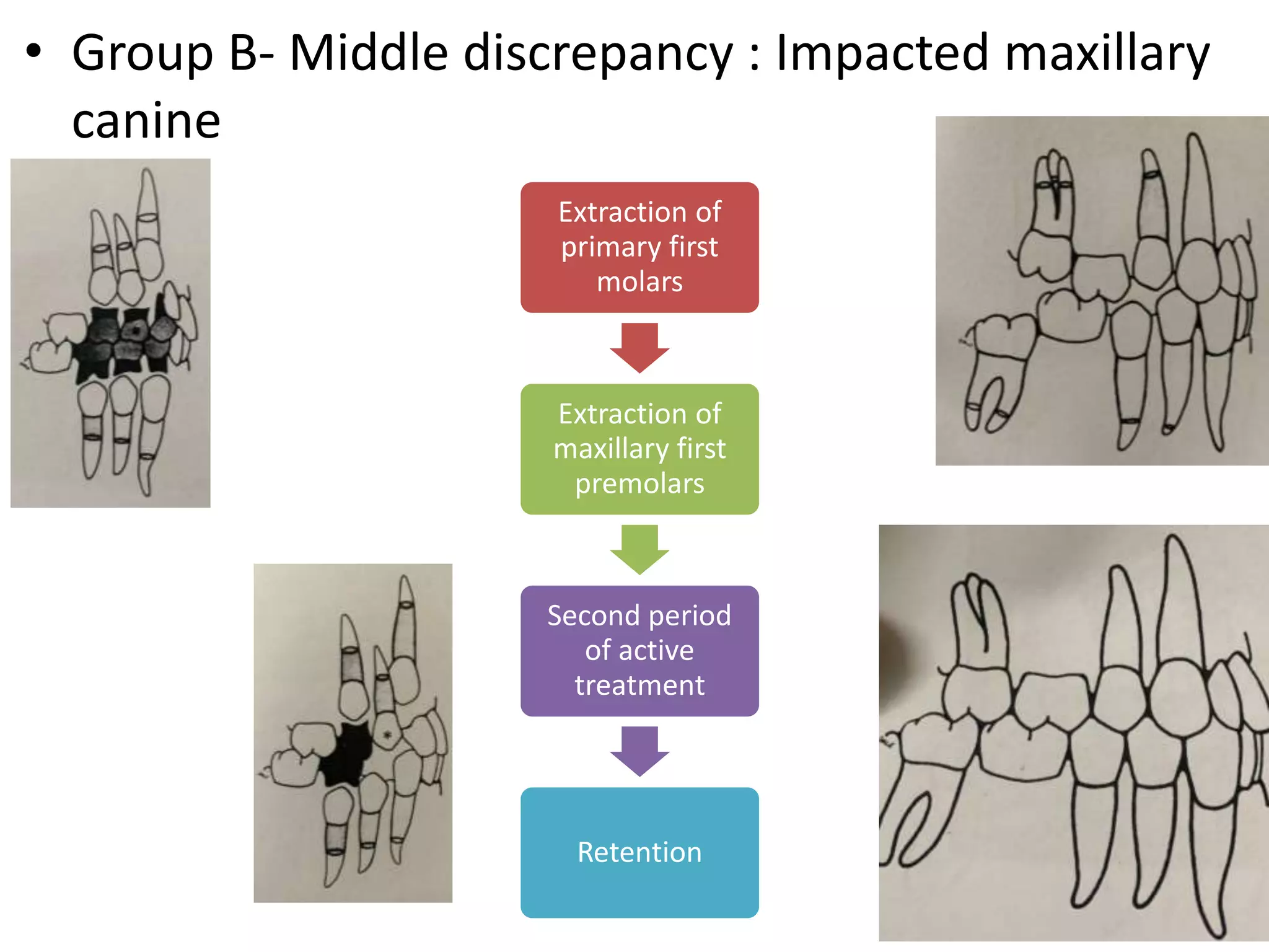 serial extraction | PPTX