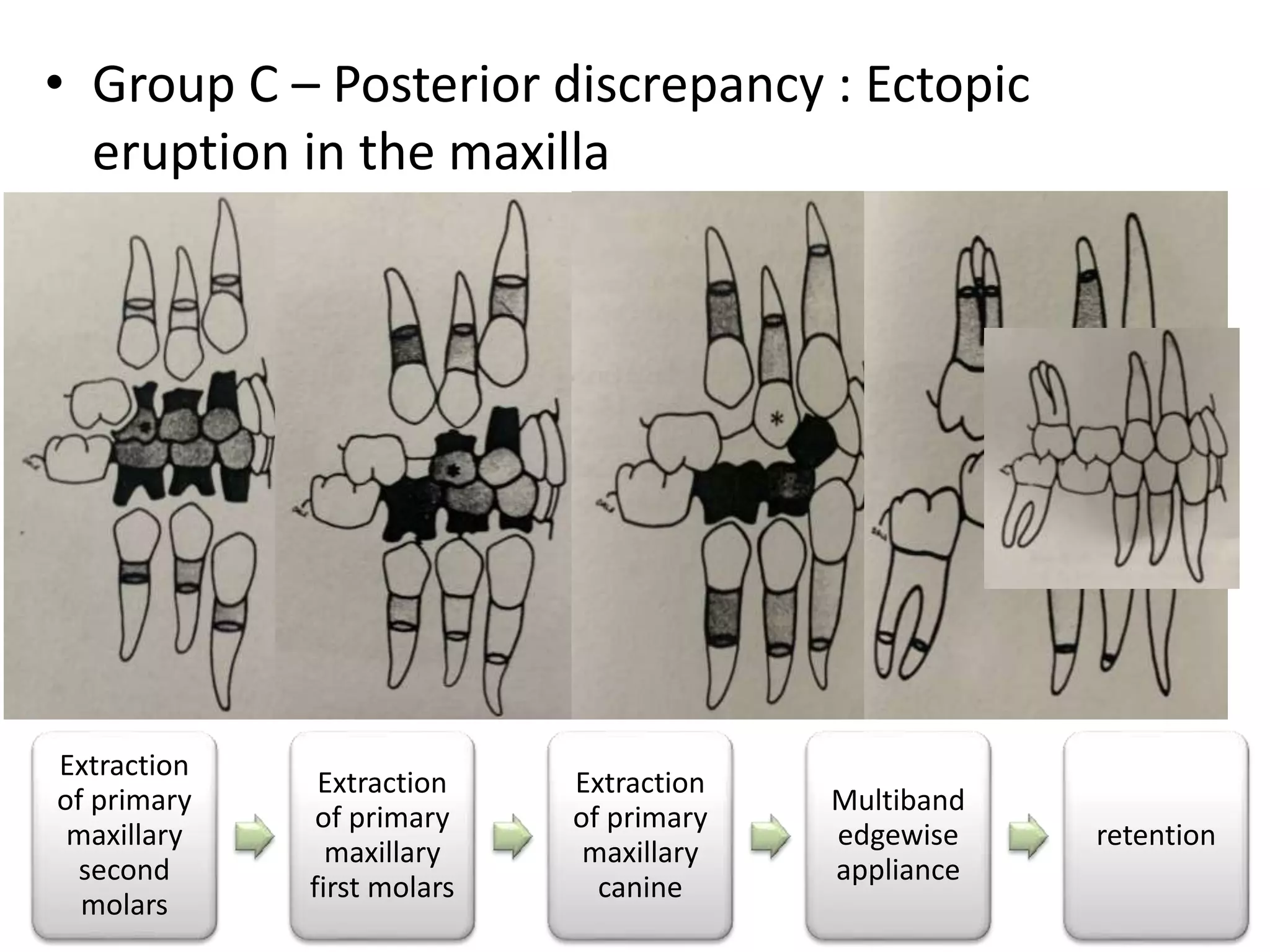 serial extraction | PPTX