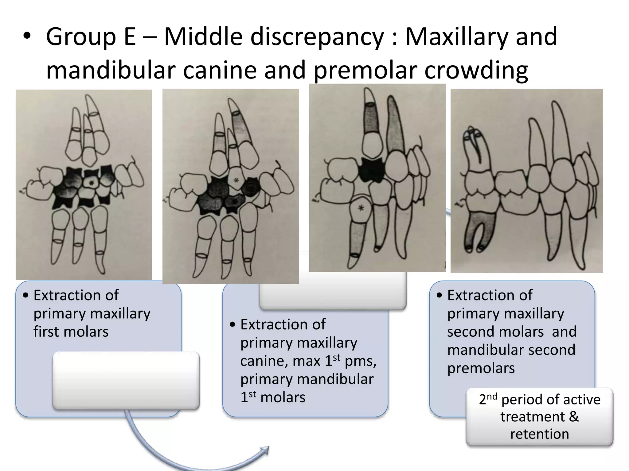 serial extraction | PPTX