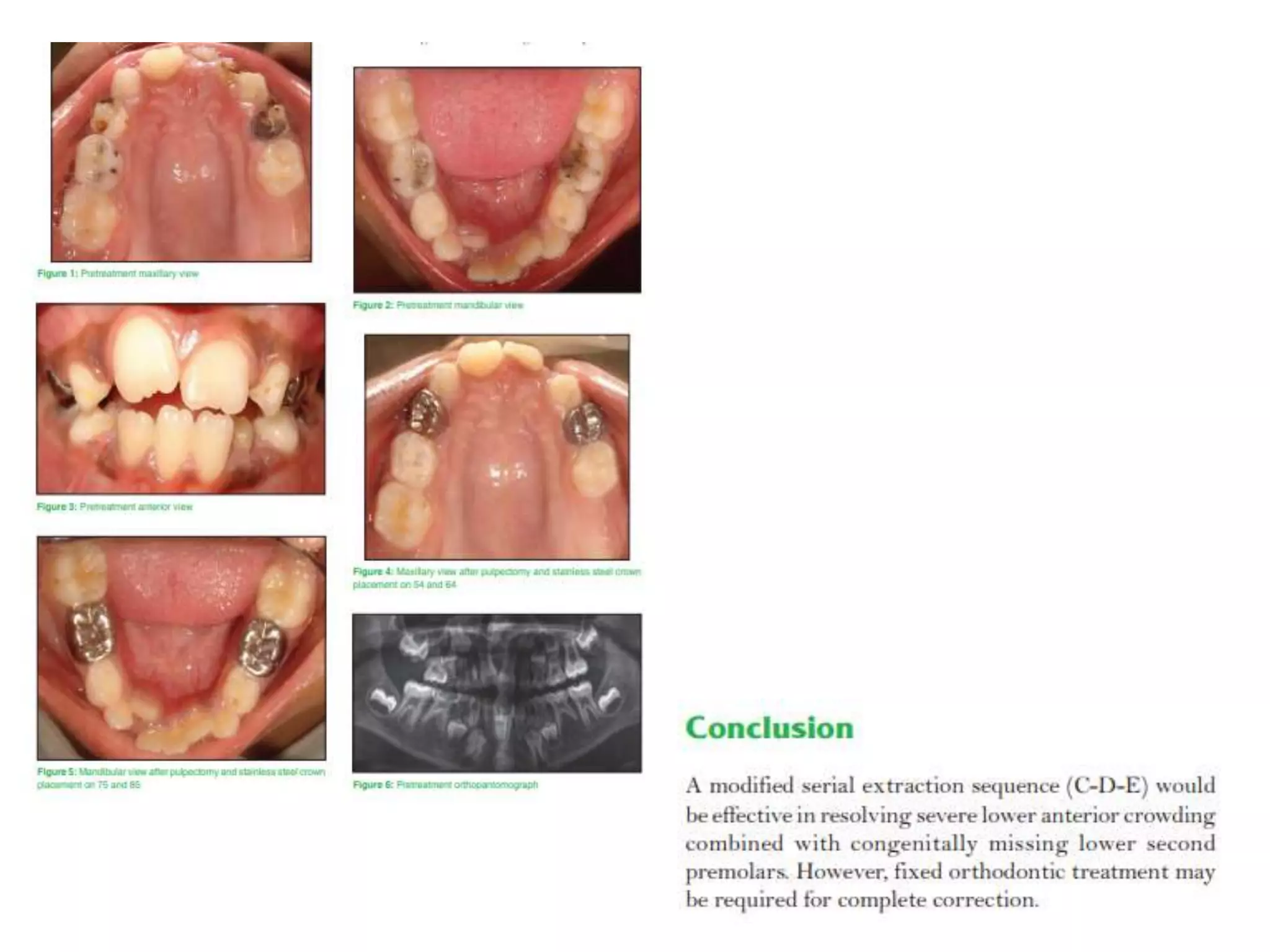 serial extraction | PPTX