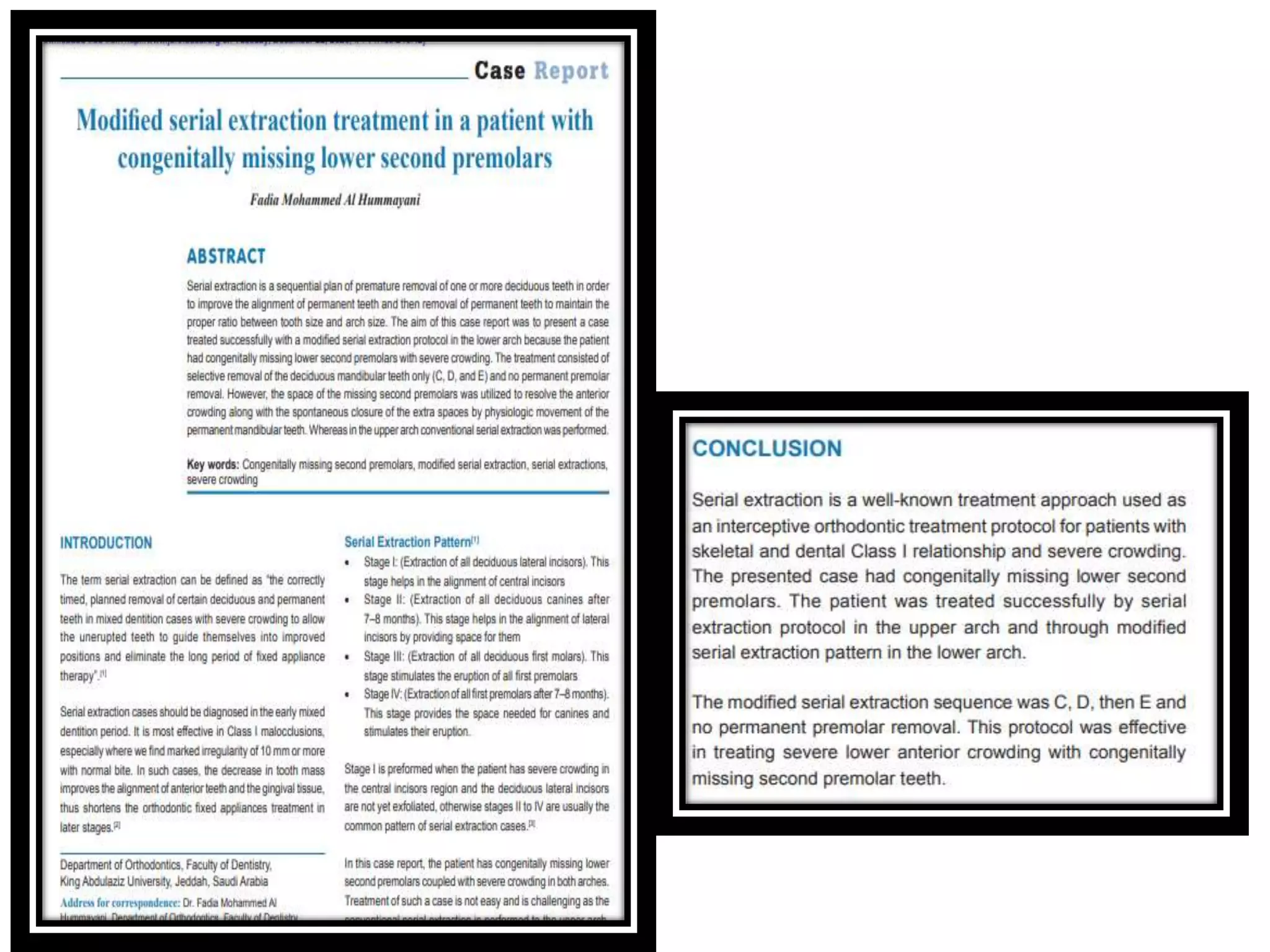 serial extraction | PPTX