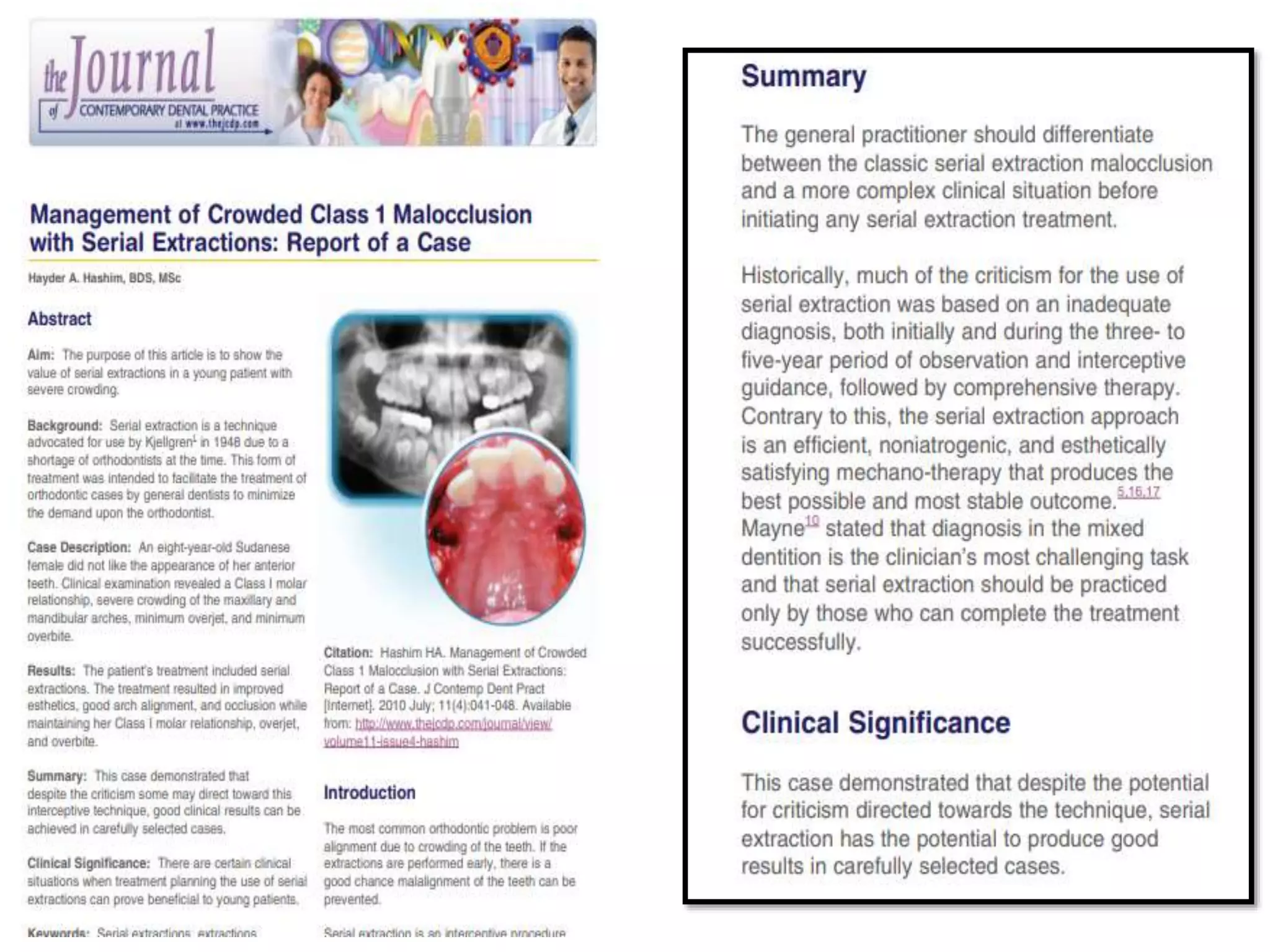 serial extraction | PPTX