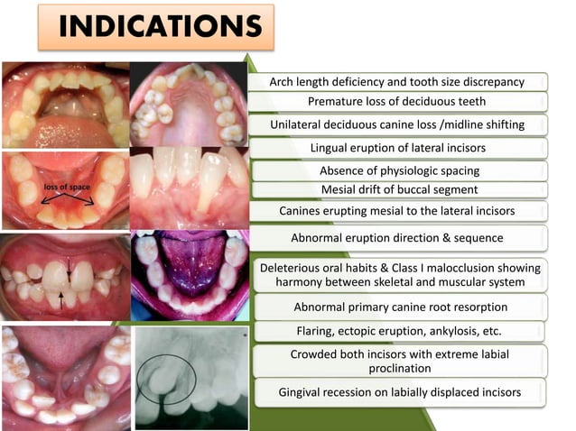 serial extraction | PPT