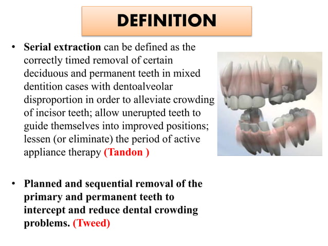 serial extraction | PPT