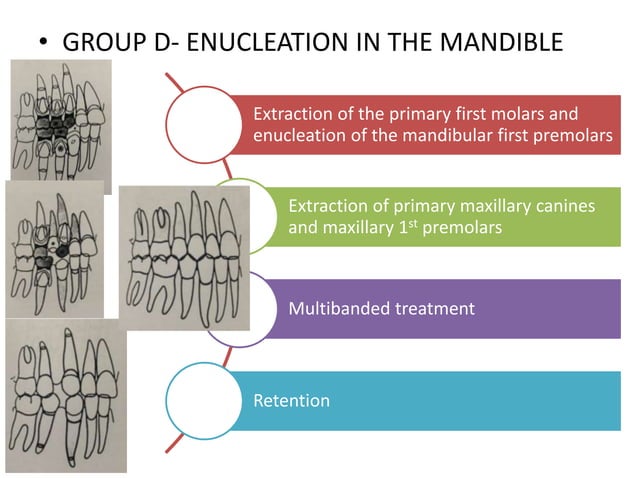 serial extraction | PPTX