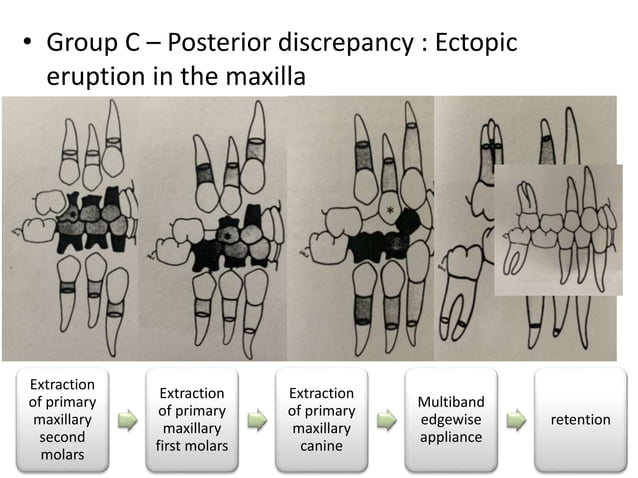 serial extraction | PPTX