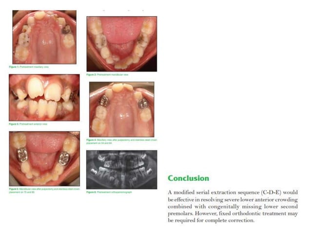 serial extraction | PPTX