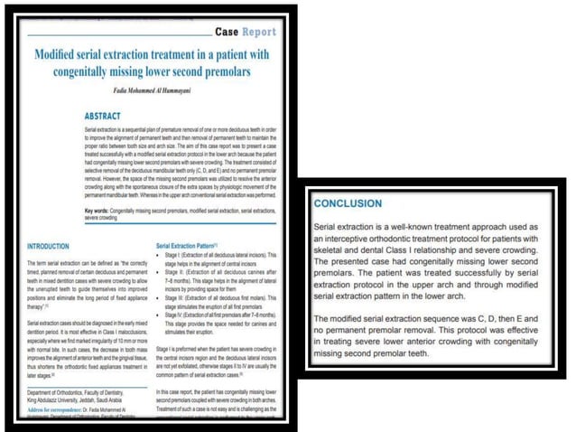 serial extraction | PPTX