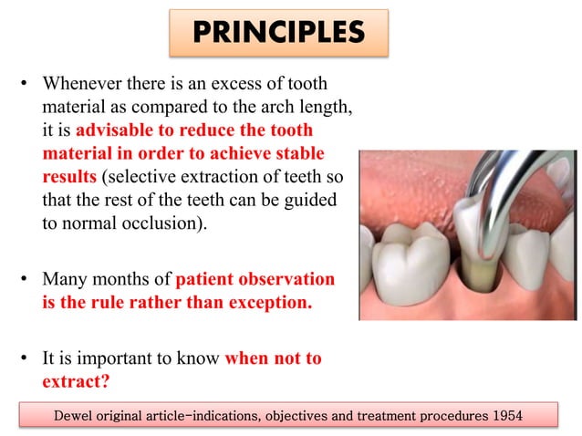 serial extraction | PPTX