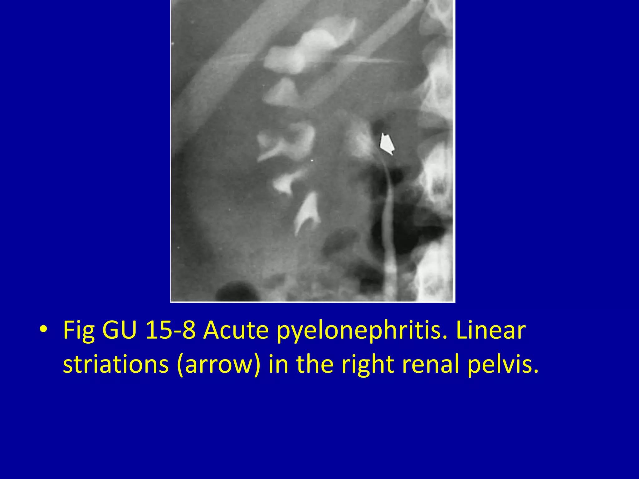 15 solitary or multiple filling defects in the | PPT