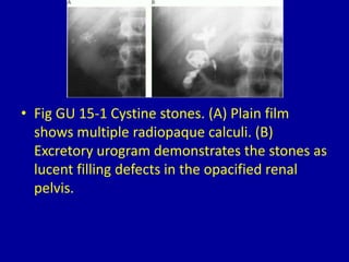 15 solitary or multiple filling defects in the | PPTX