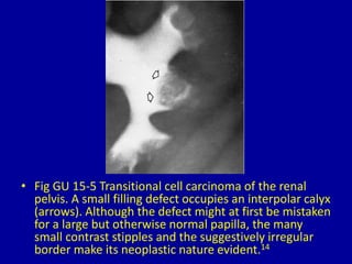 15 solitary or multiple filling defects in the | PPTX