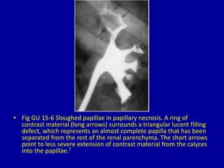 15 solitary or multiple filling defects in the | PPTX