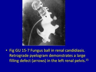 15 solitary or multiple filling defects in the | PPT