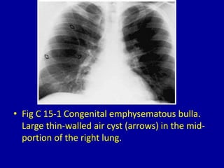 15 unilateral lobar or localized hyperlucency of the | PPTX