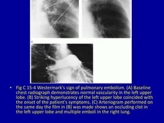 15 unilateral lobar or localized hyperlucency of the | PPTX
