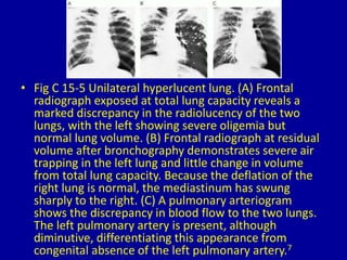 15 unilateral lobar or localized hyperlucency of the | PPTX