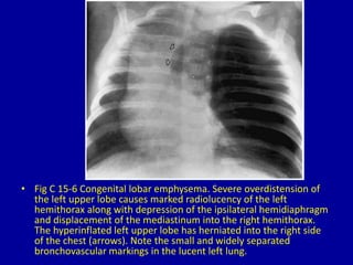 15 unilateral lobar or localized hyperlucency of the | PPTX