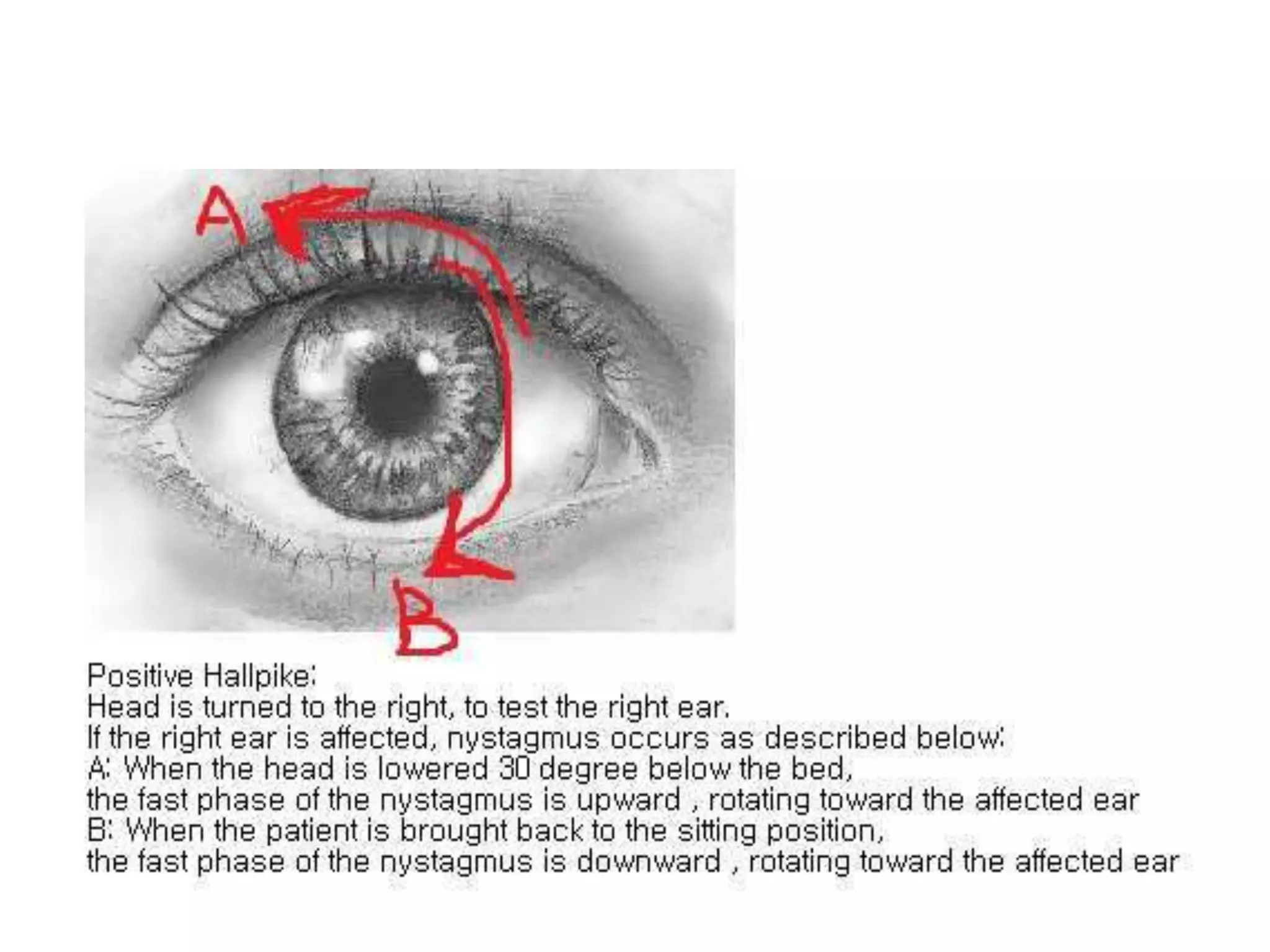 VERTIGO: CAUSES & MANAGEMENT | PPTX