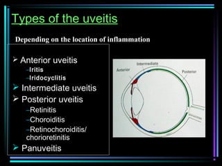 Uveitis | PPT