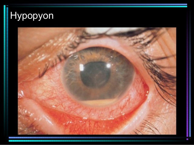 Uveitis