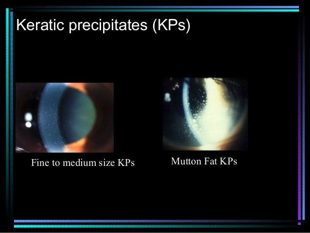 Uveitis