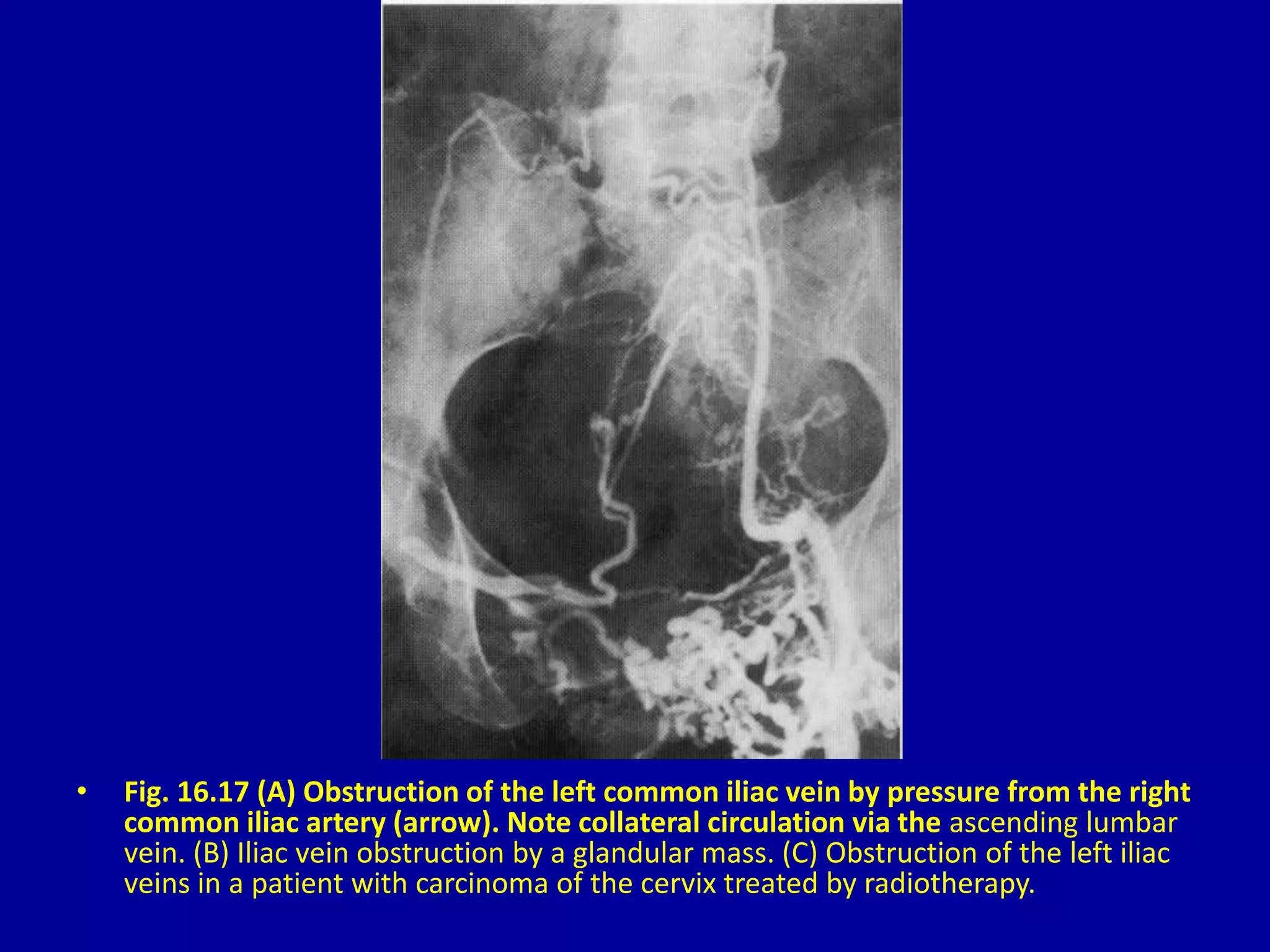 16 DAVID SUTTON PICTURES Phlebography | PPT