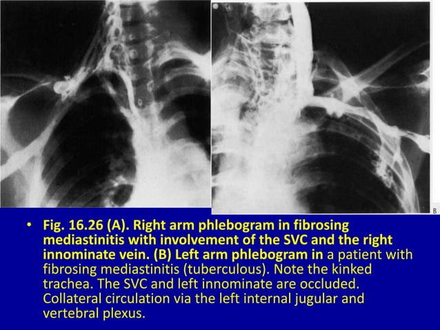 16 DAVID SUTTON PICTURES Phlebography | PPT