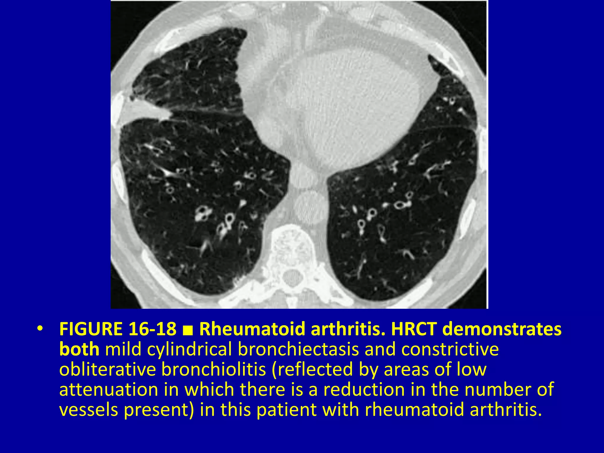 16 High Resolution Computed Tomography of Interstitial and Occupational ...