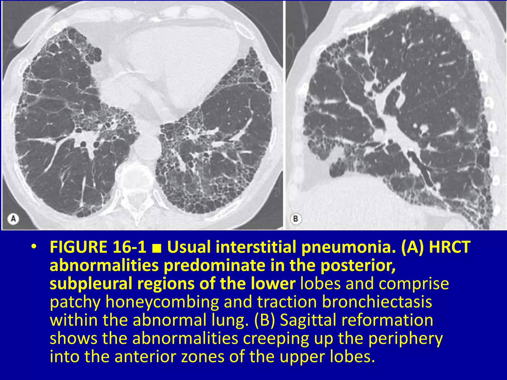 16 High Resolution Computed Tomography of Interstitial and Occupational ...