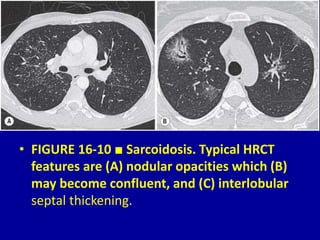 16 High Resolution Computed Tomography of Interstitial and Occupational ...